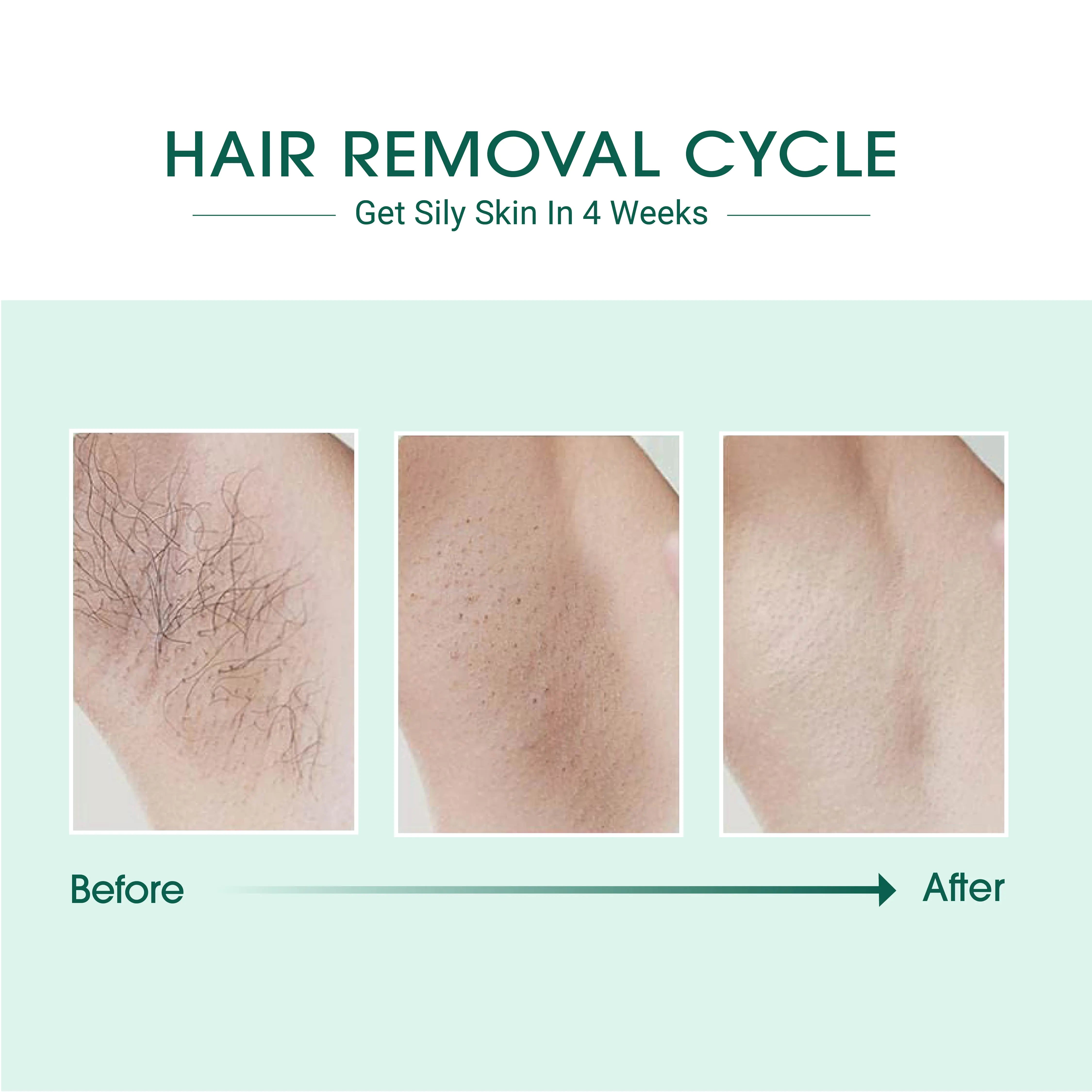 Laser IPL Hair Removal – Popular Square